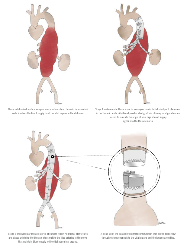 Minimally Invasive Endovascular Aortic Aneurysm Repair
