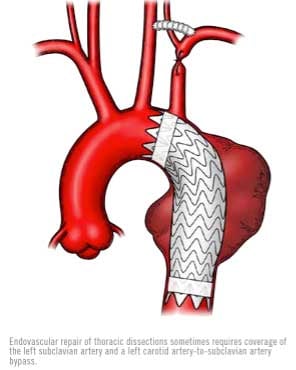 Acute Aortic Dissections